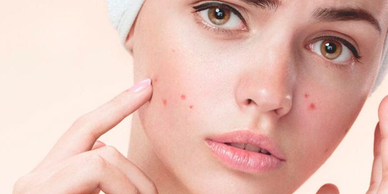 Dr. Ahu Çiler Turgut - Akne Vulgaris: Nedenleri ve Tedavisi