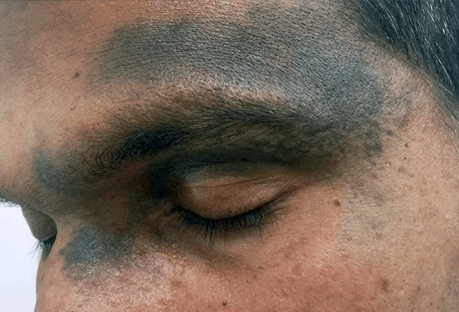 Dr. Ahu Çiler Turgut - Ota nevüs ve İto nevüs